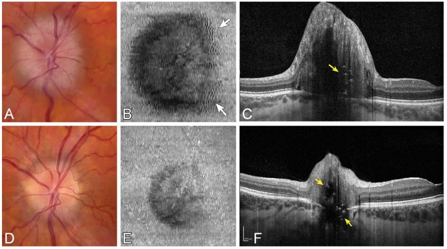 Ruolo oct nella diagnostica del papilledema